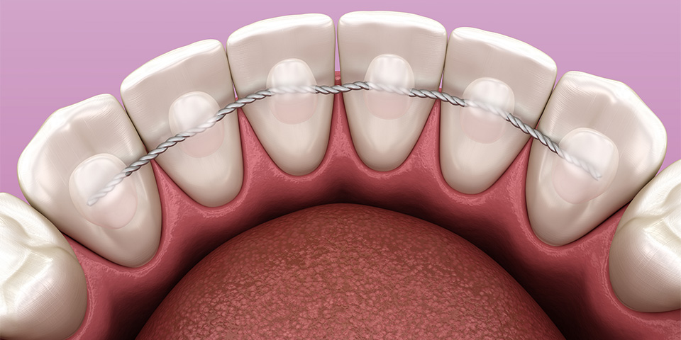 Orthodontic Retainers Replacement Services Riverdale Bronx NY