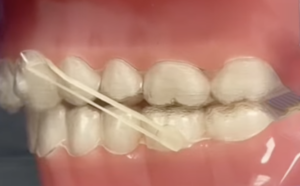 Will Rubber Bands Make My Invisalign Treatment More Noticeable?