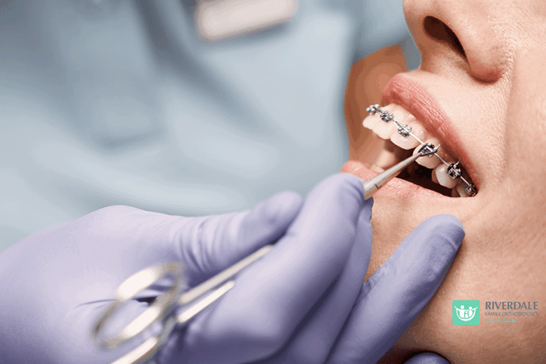 What Affects the Cost of Braces in the Bronx?